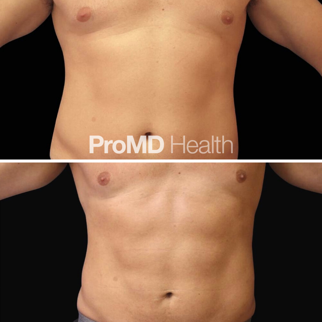 Body Treatments - ProMD Health