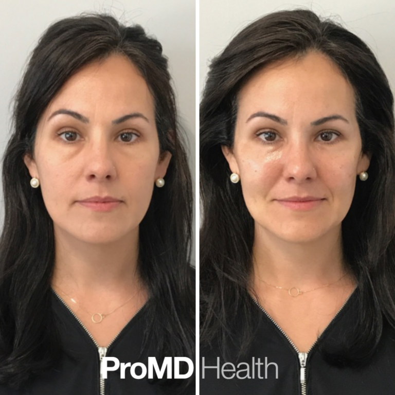 Facial Treatments | ProMD Health