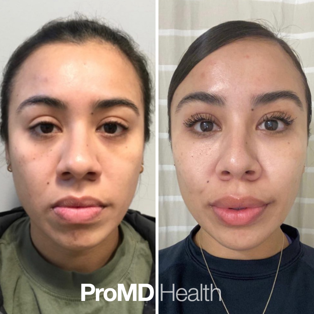 Facial Treatments | ProMD Health
