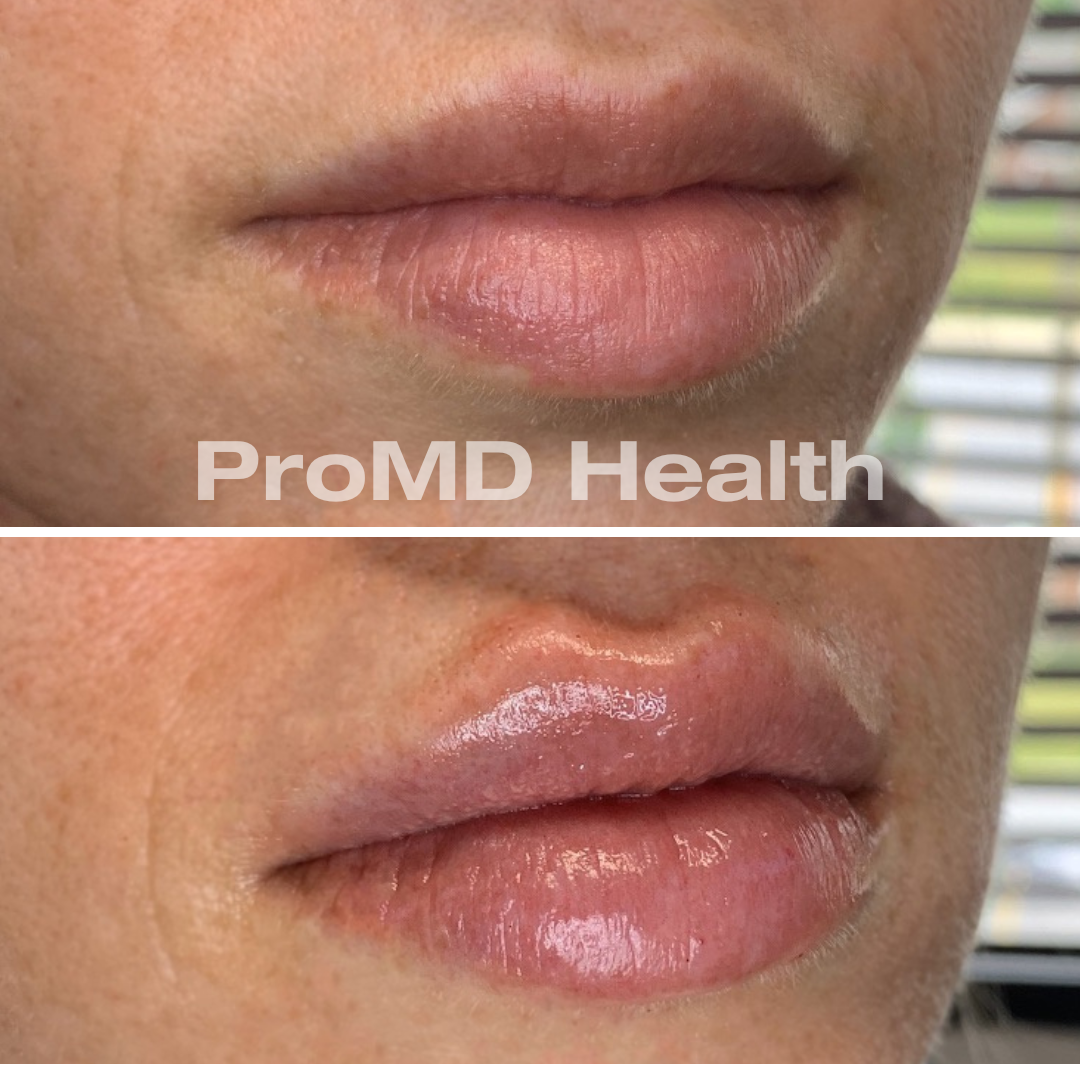 Facial Treatments | ProMD Health
