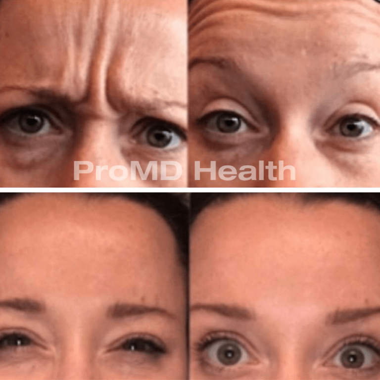 Botox Day is back Nov. 19!