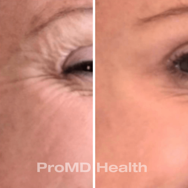 Botox, Dysport & Daxi Neurotoxin Youthful Appearance | ProMD