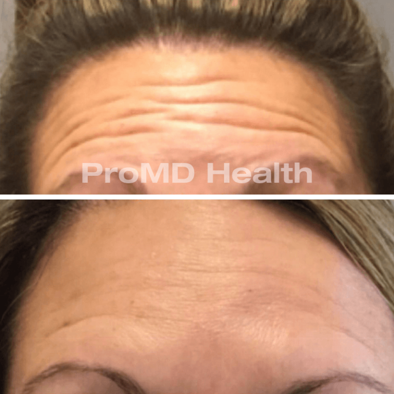 Botox Day is back Nov. 19!