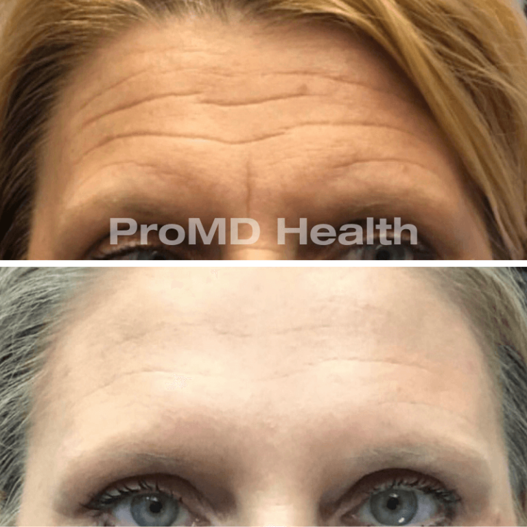Botox, Dysport & Daxi Neurotoxin Youthful Appearance | ProMD