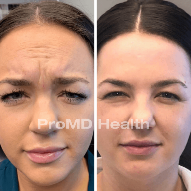 Botox Day is back Nov. 19!